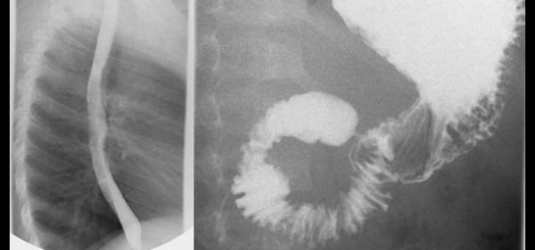 What To Expect If Your Child Needs an Upper GI Exam - Radiating Hope