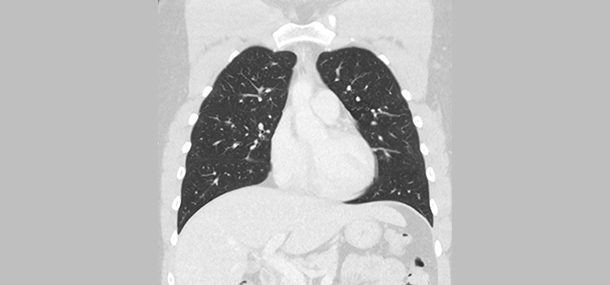What Does a CT with Contrast Feel Like? - Radiating Hope