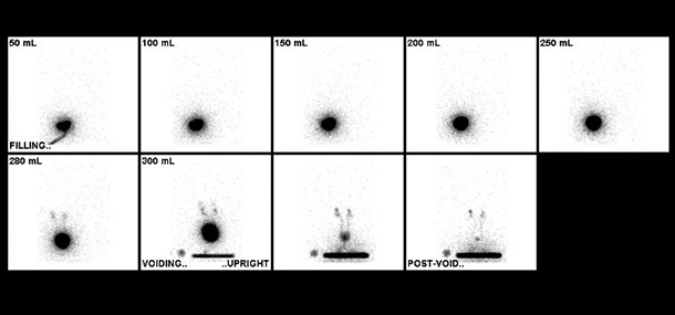 What To Expect From a Cystogram - Radiating Hope