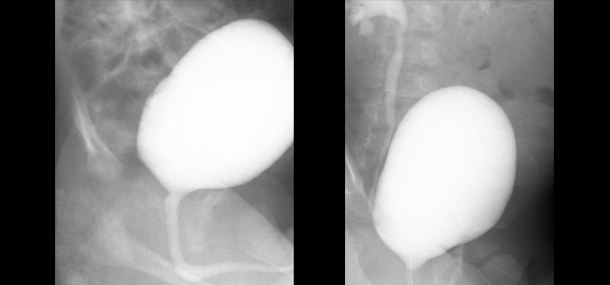 VCUG: Four Little Letters But A Lot Of Information - Radiating Hope