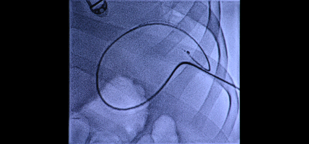 What is Interventional Radiology? - Radiating Hope