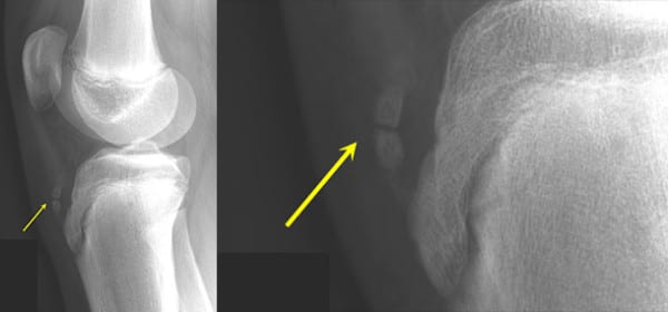 Front Knee Pain: A Common Symptom In Children - Radiating Hope