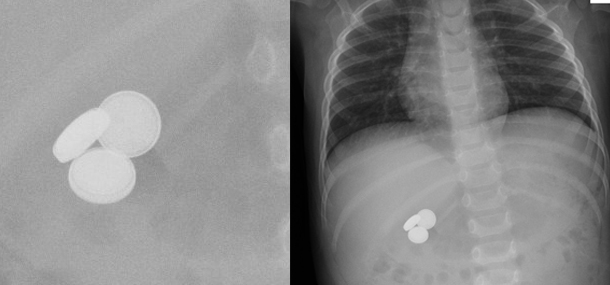 Button Batteries Can Harm Children - Radiating Hope