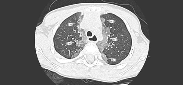 Leaders in the care of children with chILD - Radiating Hope