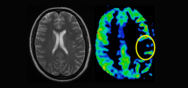What Is Advanced Neuroimaging? - Radiating Hope