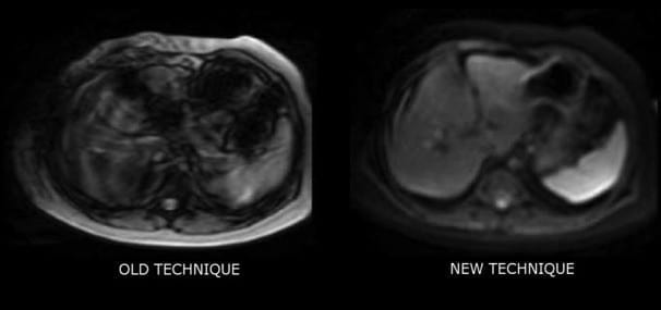 MRI Elastography: New techniques to help patients with liver disease ...