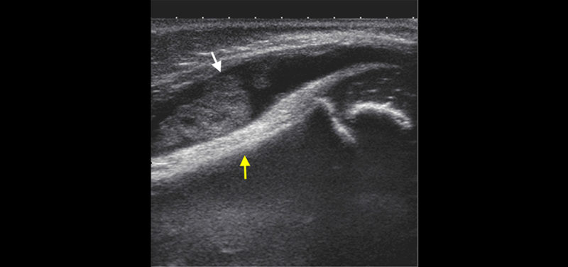 My child has a lump: Why did our pediatrician order an ultrasound ...