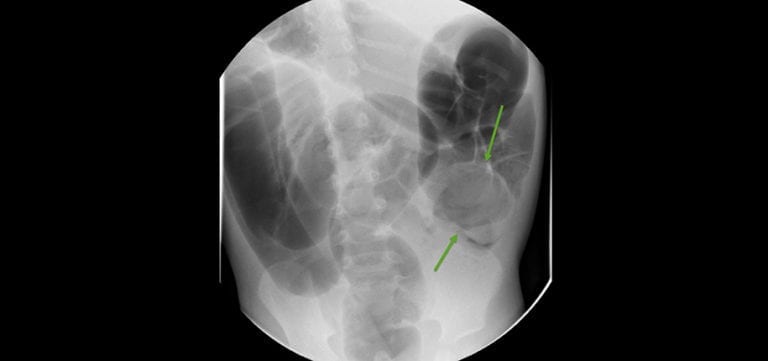 What Is Intussusception? - Radiating Hope