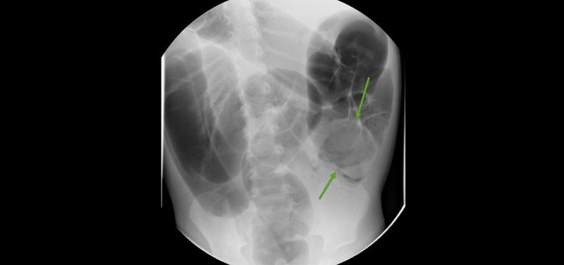 What Is Intussusception? - Radiating Hope