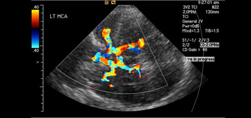 Ultrasound's Transcranial Doppler Imaging Checks for Risk of Stroke ...