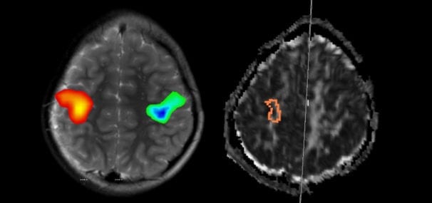 What Is Functional MRI? Our Expert Explains - Radiating Hope