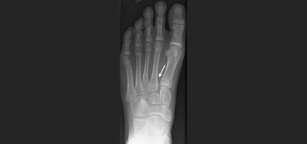 March Fractures - Radiating Hope