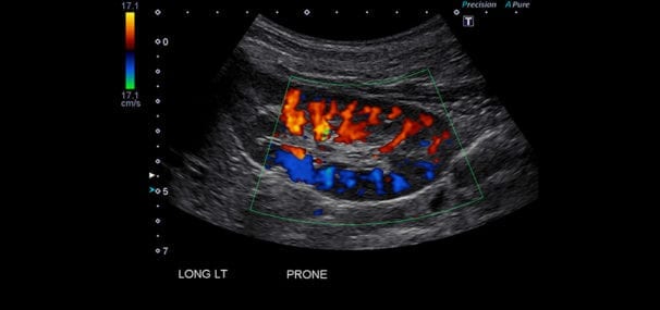 Imaging Urinary Tract Infections in Children - Radiating Hope