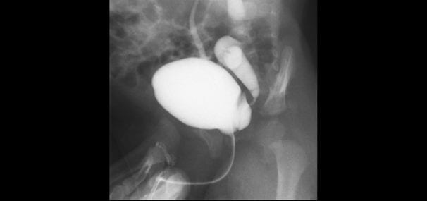 Imaging Urinary Tract Infections in Children - Radiating Hope