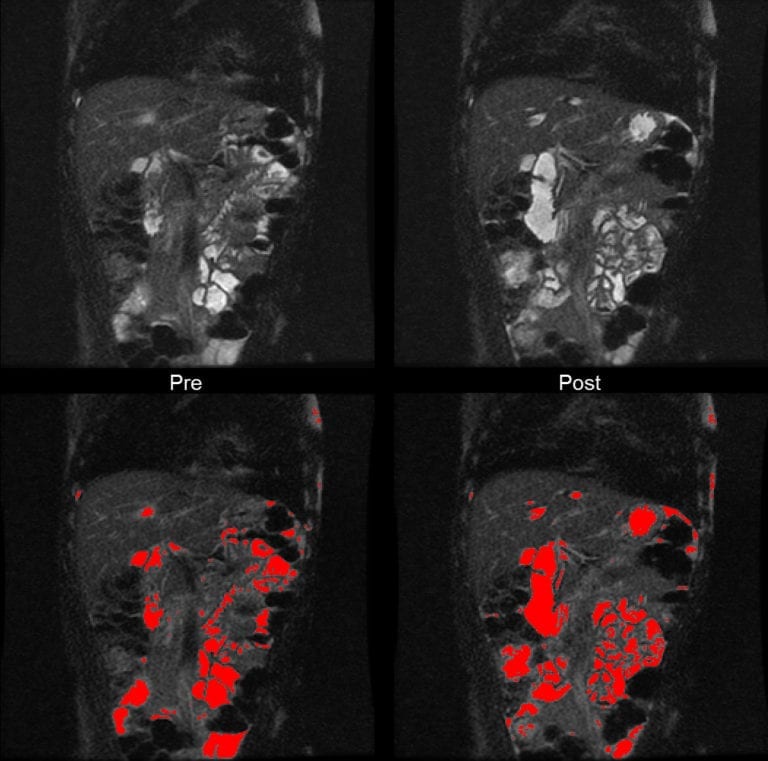 Dr. Andrew Trout heads new pancreas study - Radiating Hope