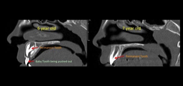 Odontogenesis, or The Formation of Teeth - Radiating Hope
