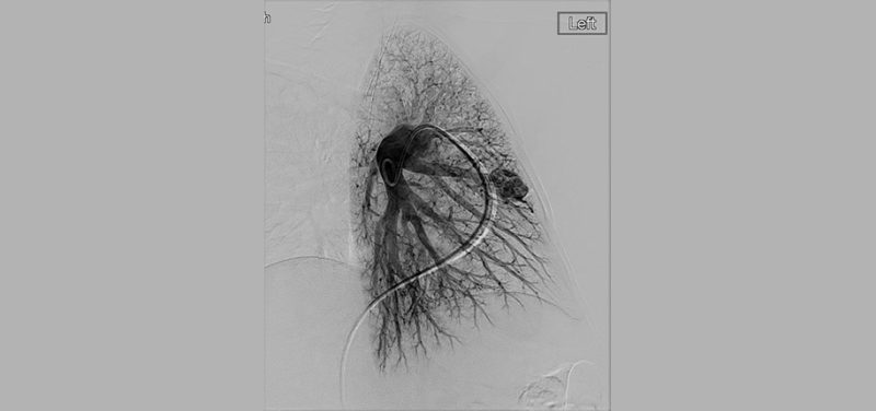 The HHT (Hereditary Hemorrhagic Telangiectasia) Center of Excellence at ...