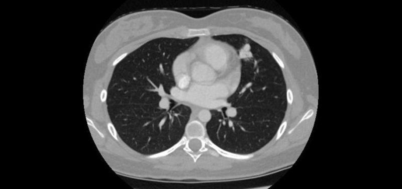 The HHT (Hereditary Hemorrhagic Telangiectasia) Center of Excellence at ...