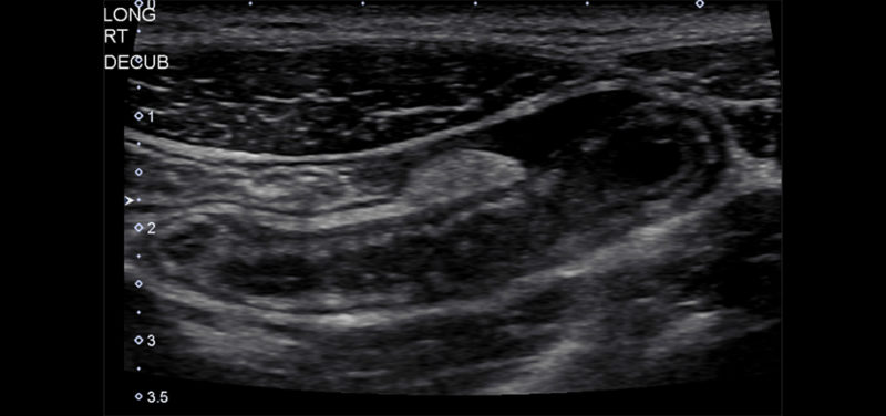 Appendicitis – Then and Now - Radiating Hope