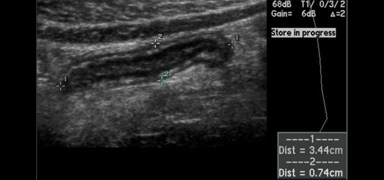 Appendicitis – Then and Now - Radiating Hope
