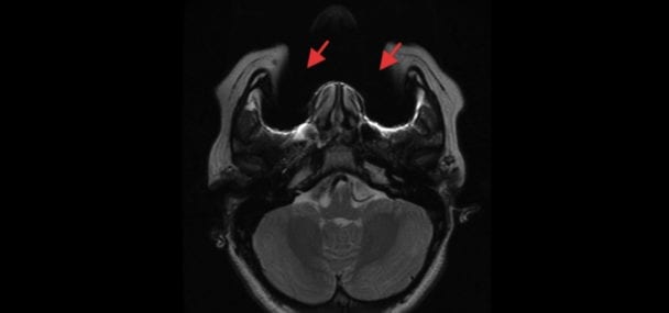 Is it safe for my child with braces to have an MRI? - Radiating Hope