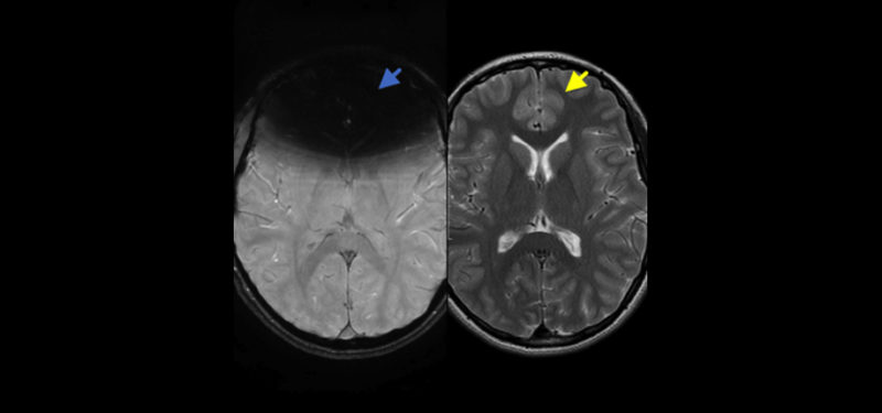Is it safe for my child with braces to have an MRI? - Radiating Hope