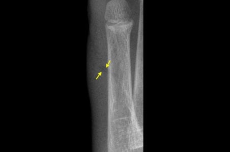 Watch Your Step! Soft tissue foreign bodies in the foot - Radiating Hope