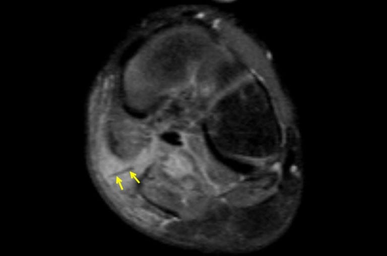 Watch Your Step! Soft tissue foreign bodies in the foot - Radiating Hope
