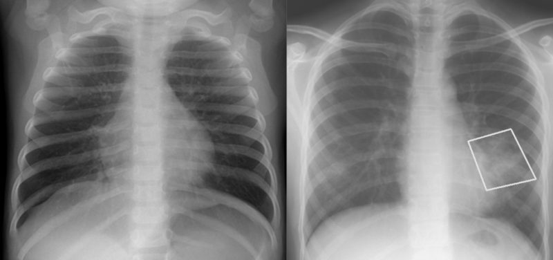 Winter Respiratory Illnesses in Children - Radiating Hope