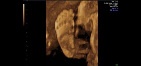 Fetal Imaging Using 3D Ultrasound - Radiating Hope