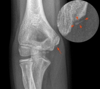 Little League Elbow - Radiating Hope