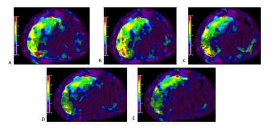 Shortening your breath holds for MR Elastography studies - Radiating Hope