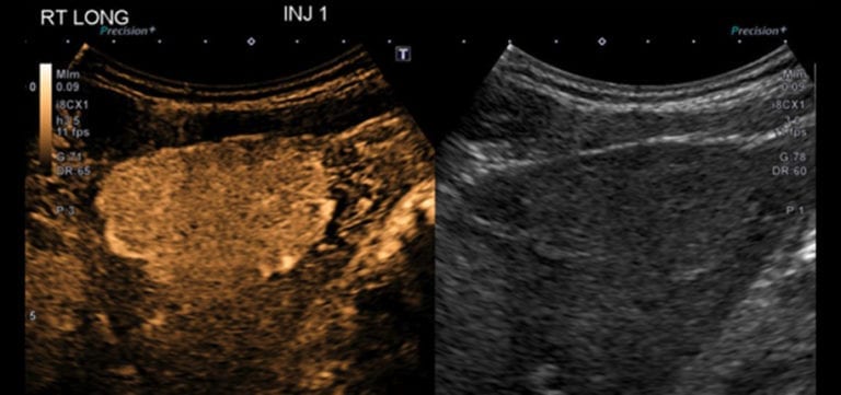 Imaging with Microbubbles: Contrast Enhanced Ultrasound - Radiating Hope
