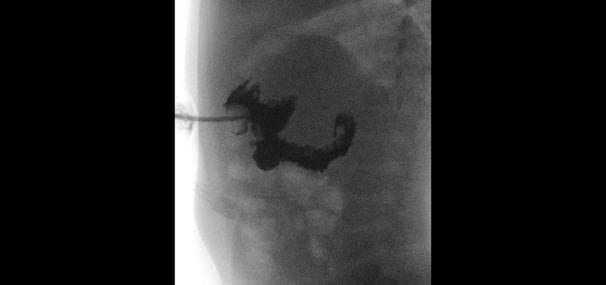 What is Intestinal Malrotation and Volvulus? - Radiating Hope