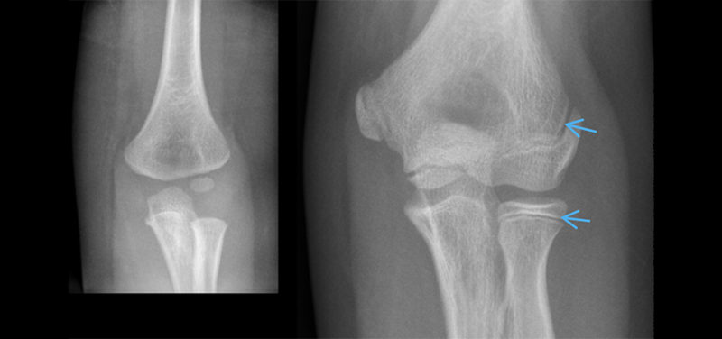 Why Kids’ Bones are So Incredibly Cool! - Radiating Hope