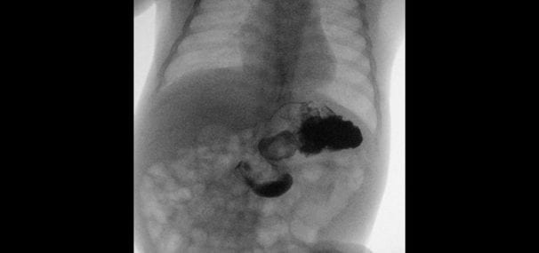 What is Intestinal Malrotation and Volvulus? - Radiating Hope