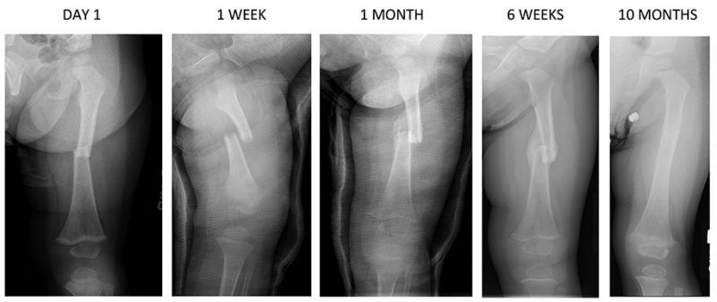 How Do Our Bones Heal After a Fracture? - Radiating Hope