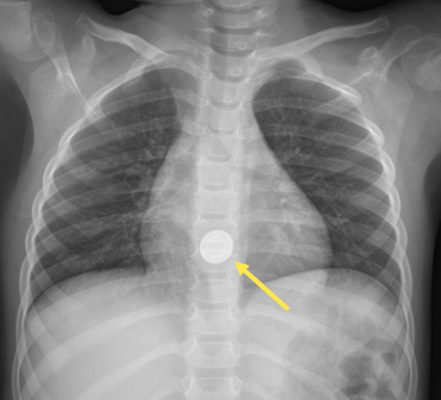 Holiday Safety Reminder: Be on the lookout for button batteries ...