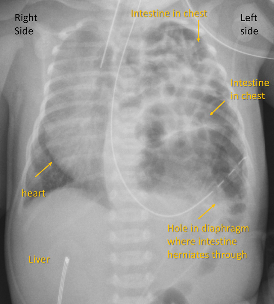 Hernias in kids? - Radiating Hope