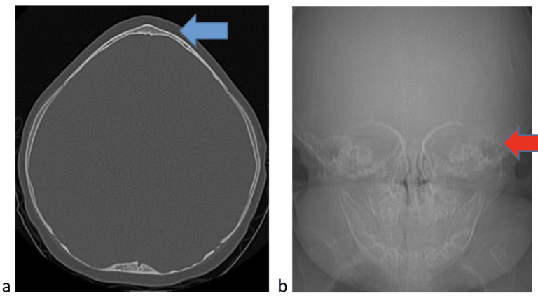 Craniosynostosis: Imaging the Misshapen Head - Radiating Hope