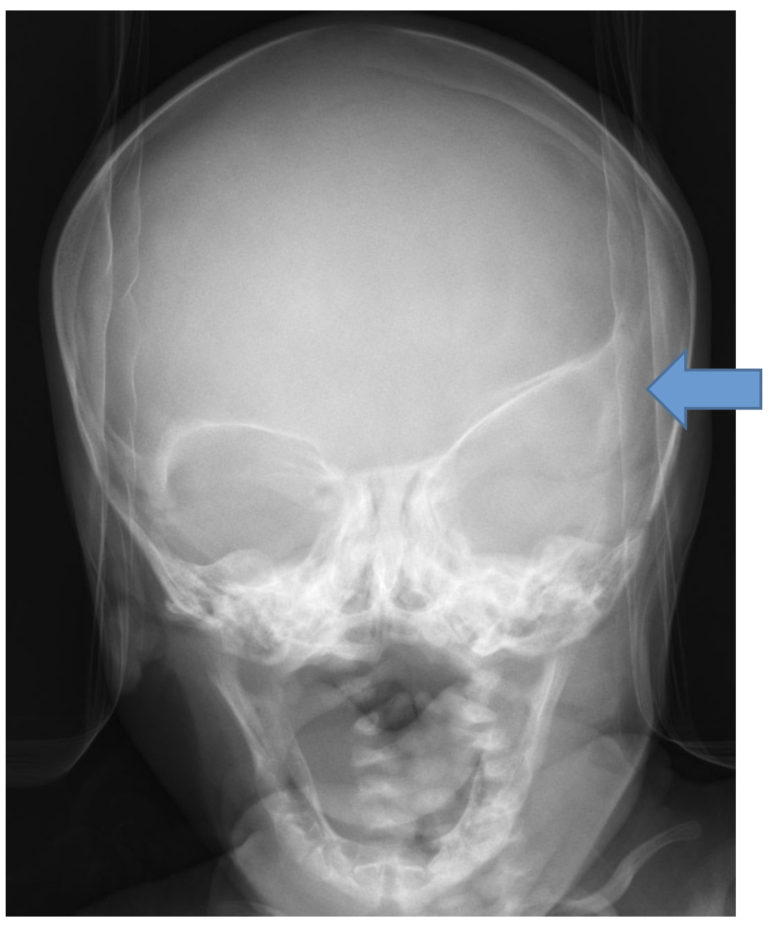 Craniosynostosis: Imaging the Misshapen Head - Radiating Hope