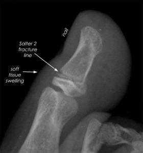 The Hidden Threat: The Stubbed Toe and Finger - Radiating Hope