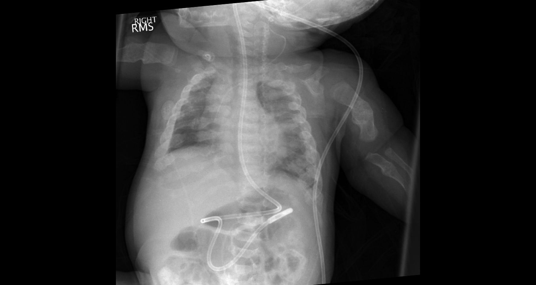 What Can a Chest X-ray Show? - Radiating Hope