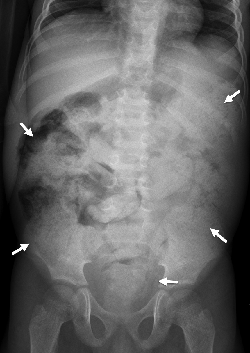 Diagnostic Contrast Enema for Chronic Constipation - Radiating Hope