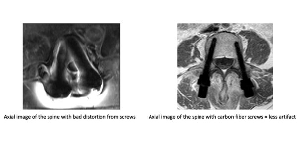 MRI Safety, Implants, Image Effects, and More - Radiating Hope