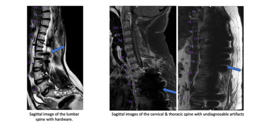 MRI Safety, Implants, Image Effects, and More - Radiating Hope
