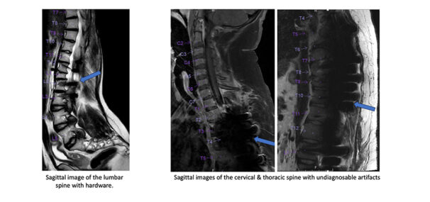 MRI Safety, Implants, Image Effects, and More - Radiating Hope