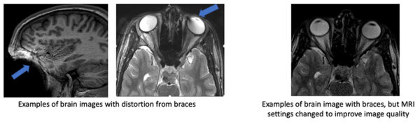 MRI Safety, Implants, Image Effects, and More - Radiating Hope