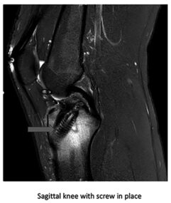 MRI Safety, Implants, Image Effects, and More - Radiating Hope