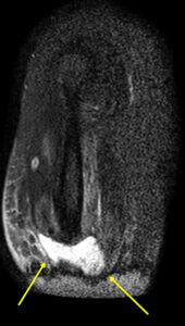 Rapid MRI for Acute Musculoskeletal Infection Protocol - Radiating Hope